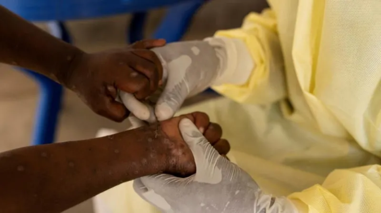 First case of more dangerous mpox found outside Africa – The Island
